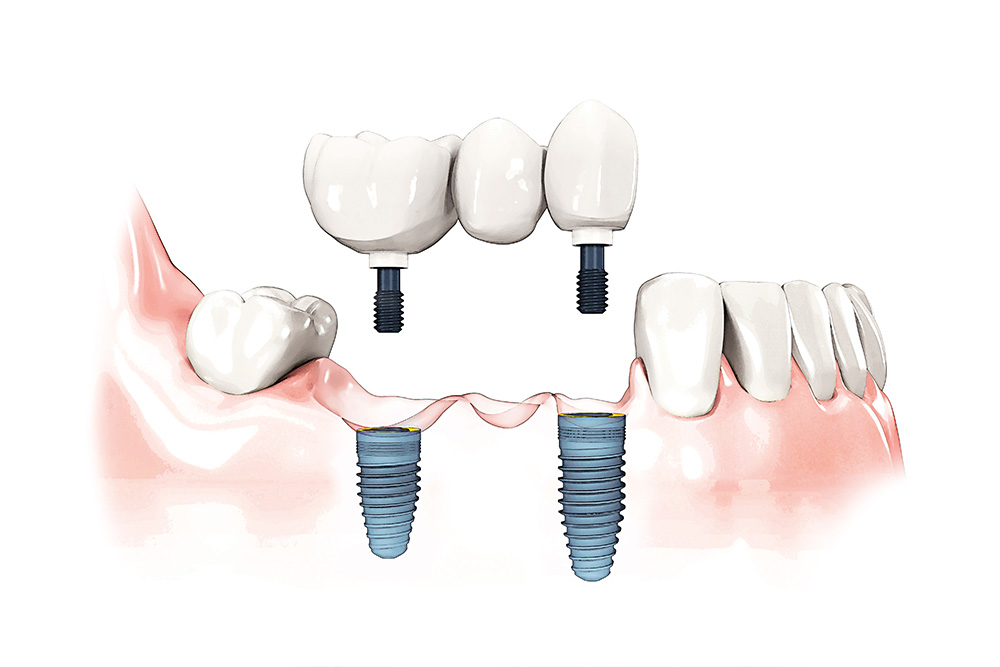 Multiple Teeth Implants San Francisco | Dental Implant Center