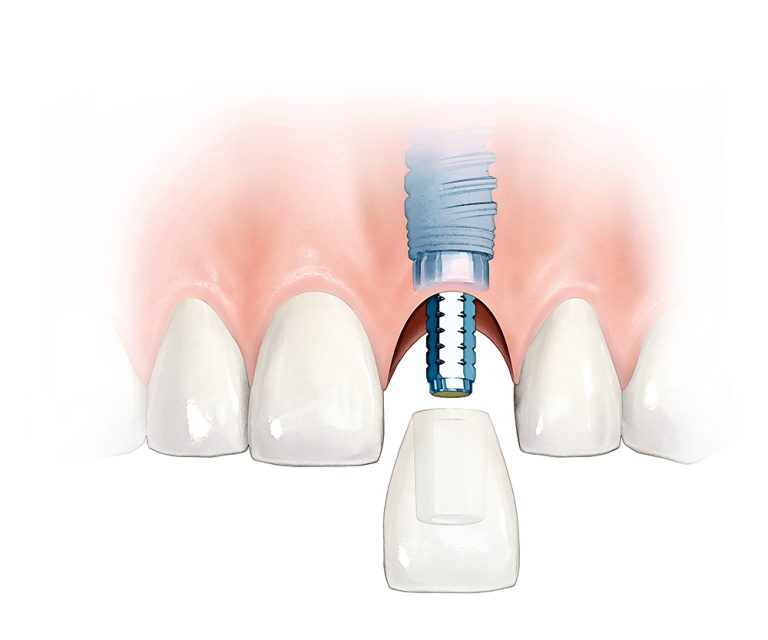 Single Tooth Implants | San Francisco Dental Implants Center