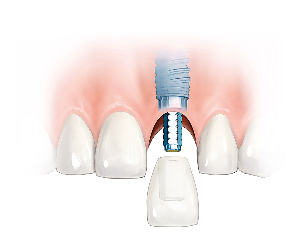 Single Tooth Implants | San Francisco Dental Implants Center