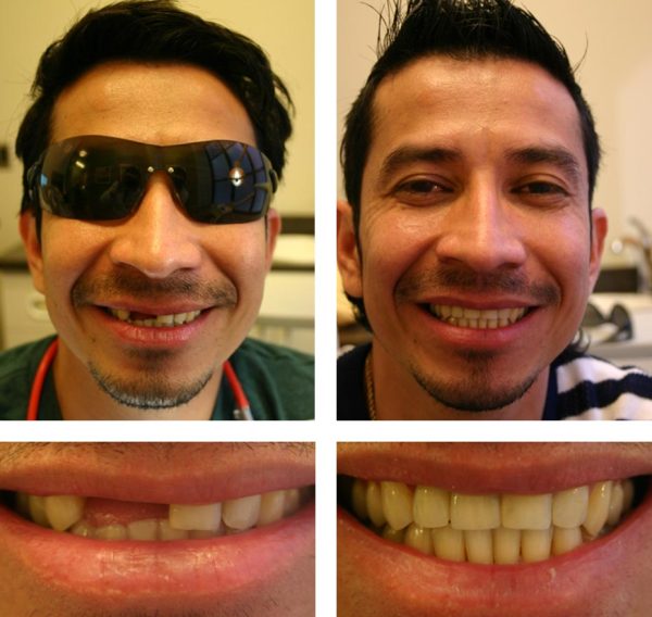 Single Tooth Implants | San Francisco Dental Implants Center