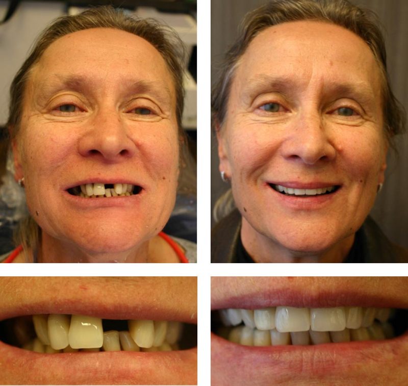 Single Tooth Implants | San Francisco Dental Implants Center