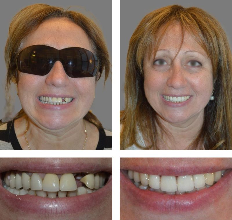San Francisco Dental Implant Center Announces Updated Before and After ...