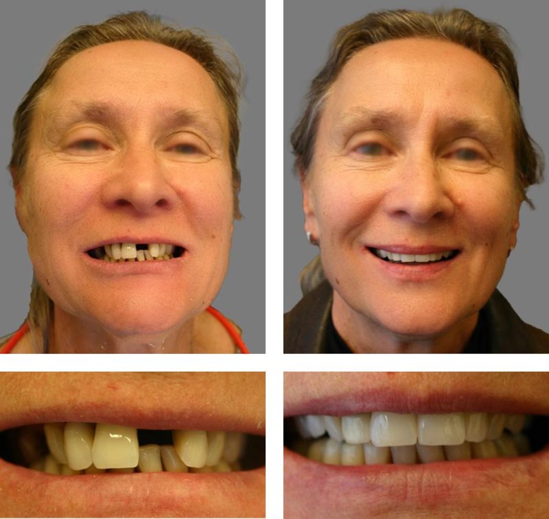 Single Tooth Implants | San Francisco Dental Implants Center